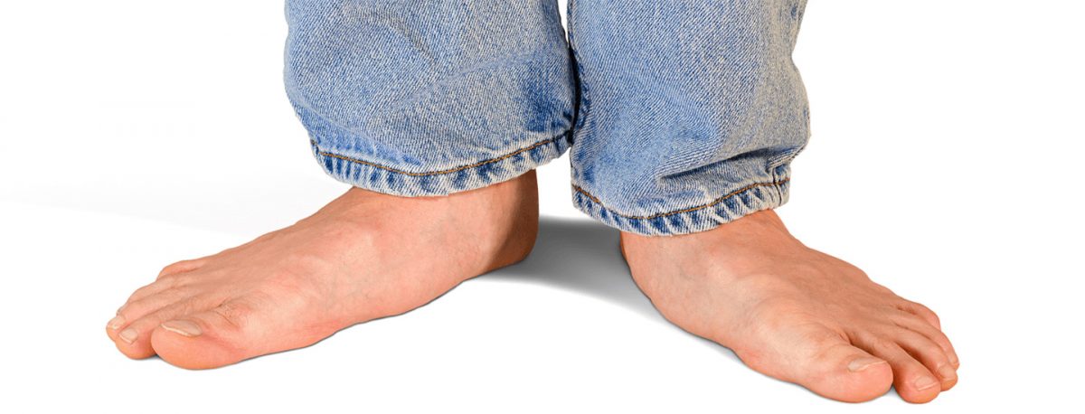 Flat Feet (Pes Planus) Adults & Children | Revesbypodiatryclinic