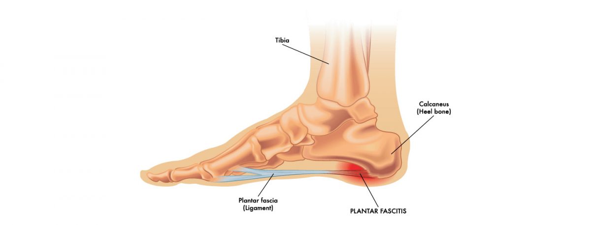 Heel Pain/Plantar Fasciitis | Revesbypodiatryclinic